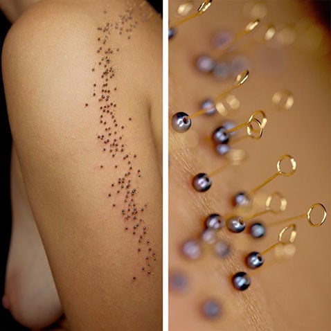 Nevus Comedonicus Photos